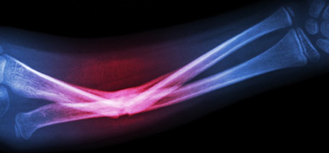 Knochenbrüche mit Stammzellen heilen