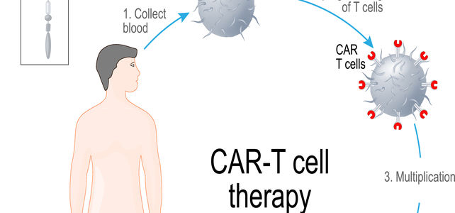 Versorgung mit CAR-T-Zellen in Deutschland